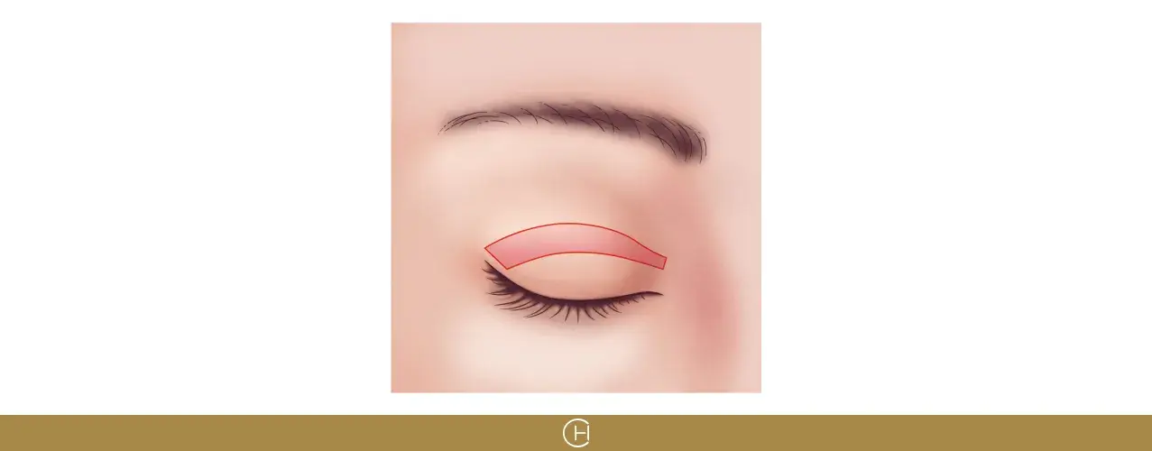 Incisional Double Eyelid Surgery - 陳宏彰醫師